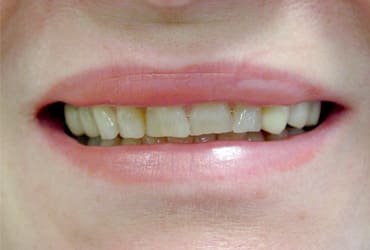 Dental Gallery | Local Dentist Results | Bloor West Smiles